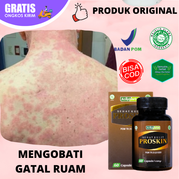Obat Ruam Di Badan, Menghilangkan Bintik Bintik Merah Alergi, Bercak ...