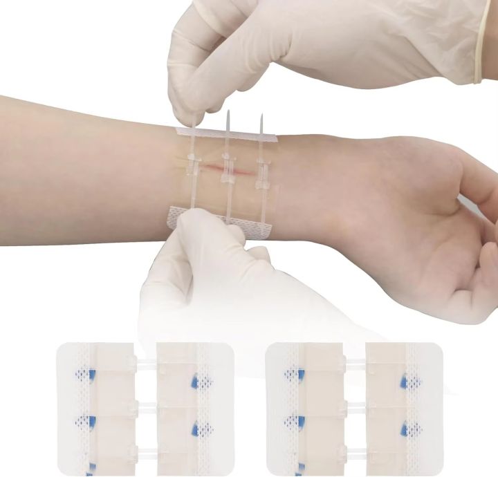 Zipper Band-Aid Wound Closure Device Wound Tie Emergency Repair Wounds ...