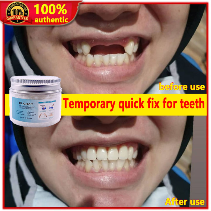 50g DIY Temporary Tooth Repair Kit Set Teeth and Gaps Resin False Teeth ...