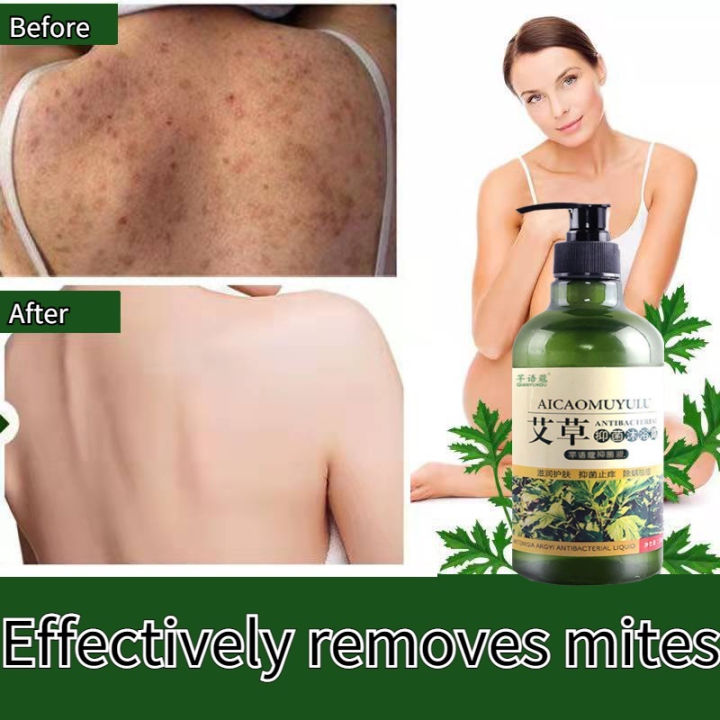 Acne Clear Body Wash 500ml Mugwort anti-mite and anti-itch shower gel Deep cleansing ...