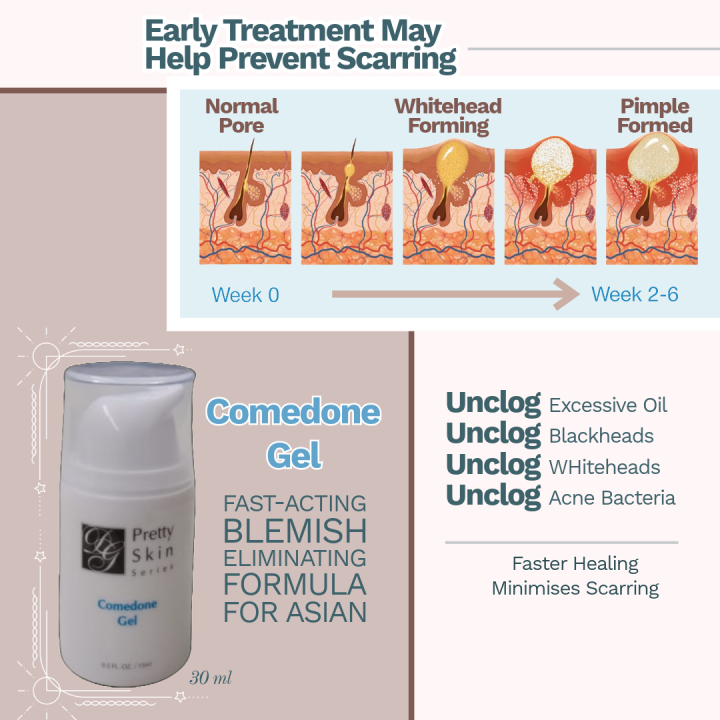 Comedones Gel 15ml (Anti-Comedone Blackheads Whiteheads Serum | Unclogs ...