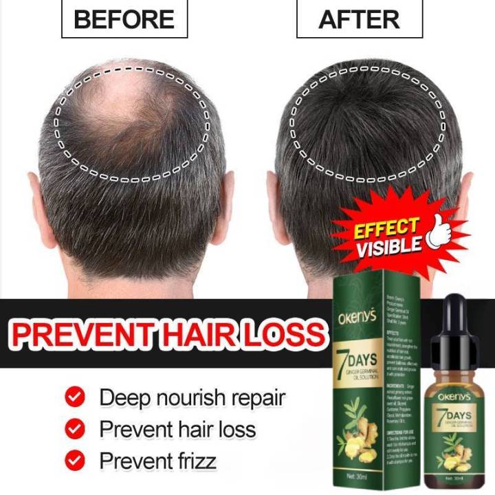 PEIMEI Hair Growth Essence Spray Minoxidil hair grower for men Anti ...
