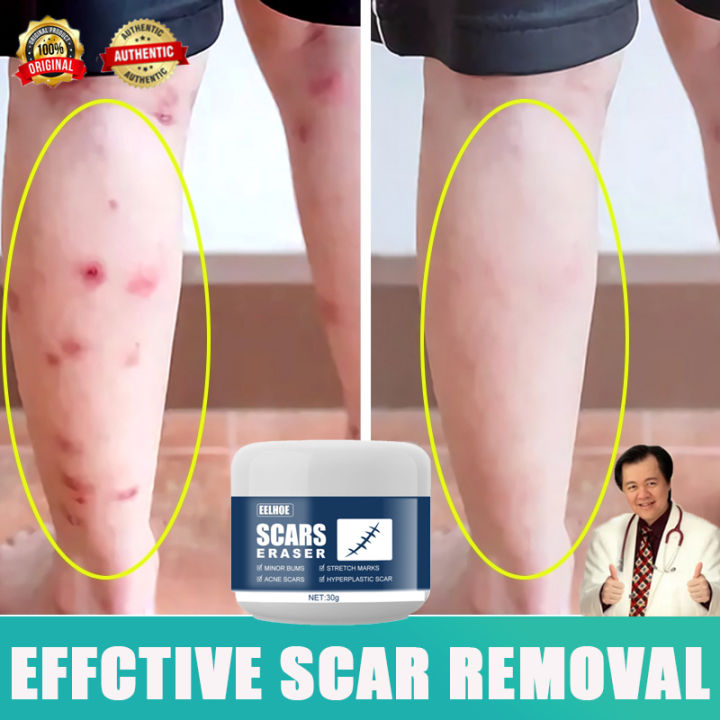 scars remover for old scars fix scar removal original peklat remover ...