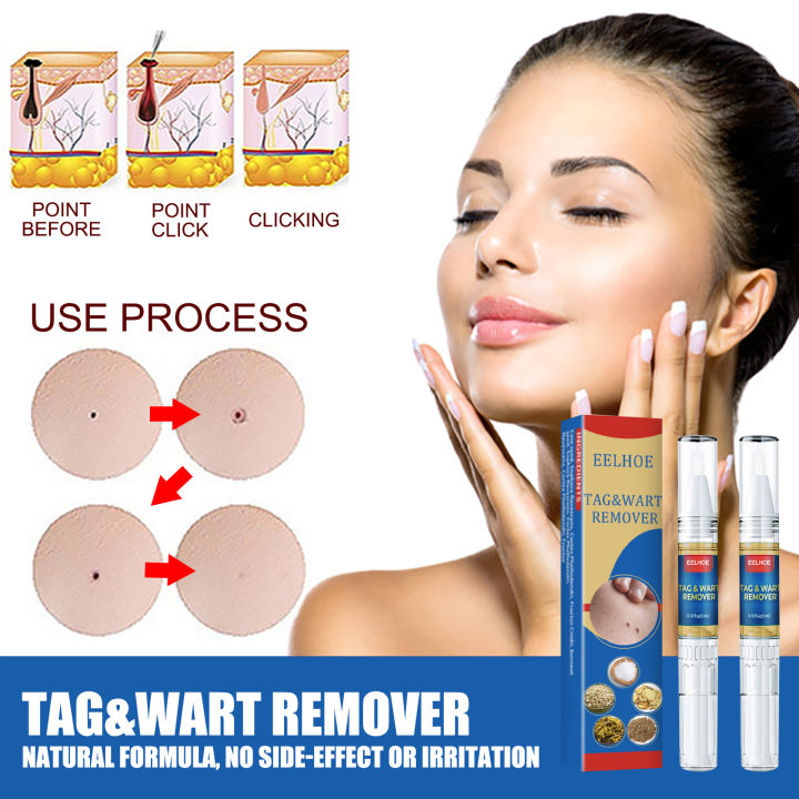 Eelhoe Tag&Wart Remover Anti Verruca Remedy Liquid Pen Treatment ...