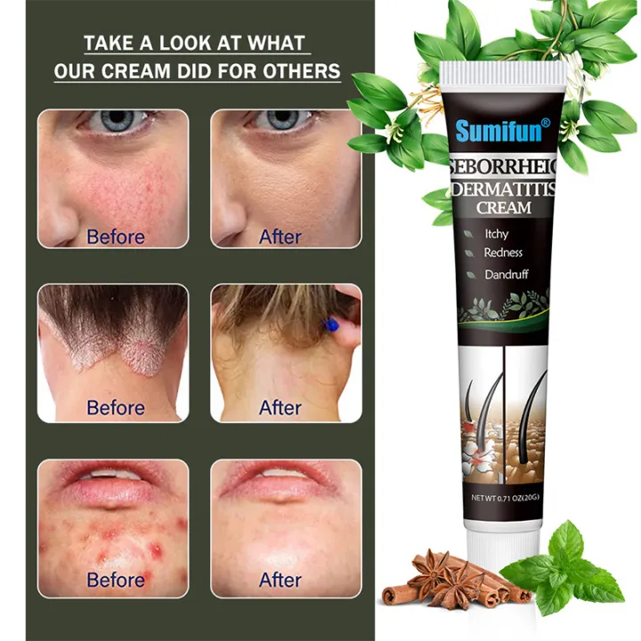 LEMOI【100% Genuine Guarantee】20G Scalp Cleansing cream Anti Dandruff ...