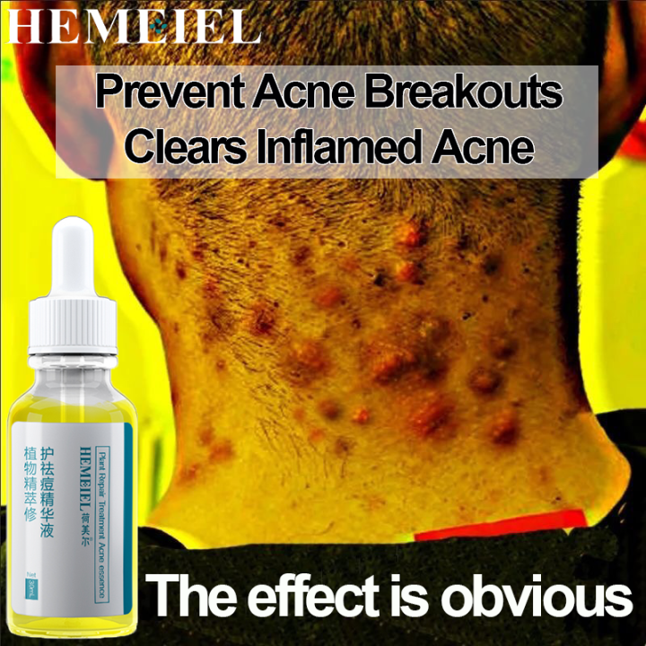 HEMEIEL Acne Serum/Gamot Sa Tagyawat Sa Mukha/Pimples & Acne Remover ...
