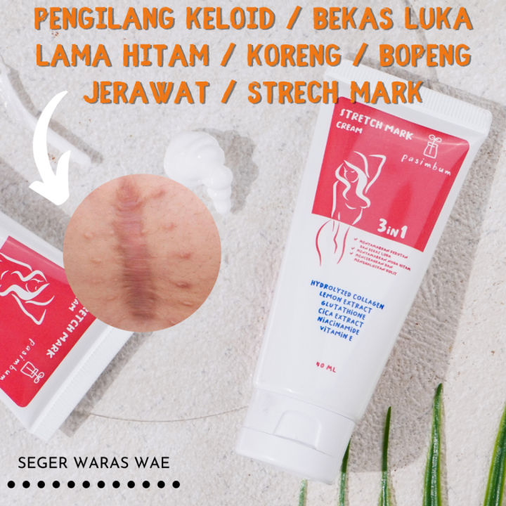 Salep Krim Penghilang Keloid Bekas Luka Stretch Mark Strechmark Cream ...