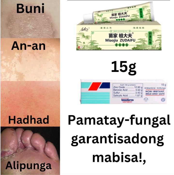 Anti-fungal Cream: Pamatay Buni, An-an, Hadhad, Alipunga at iba pang ...