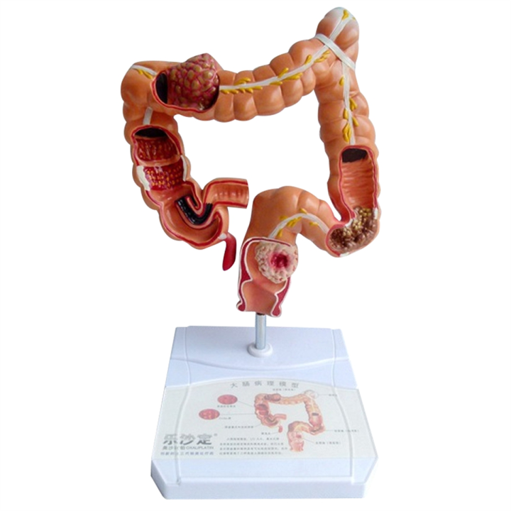Teaching Model,Human Large Intestine Anatomy Model Visceral Lesion ...