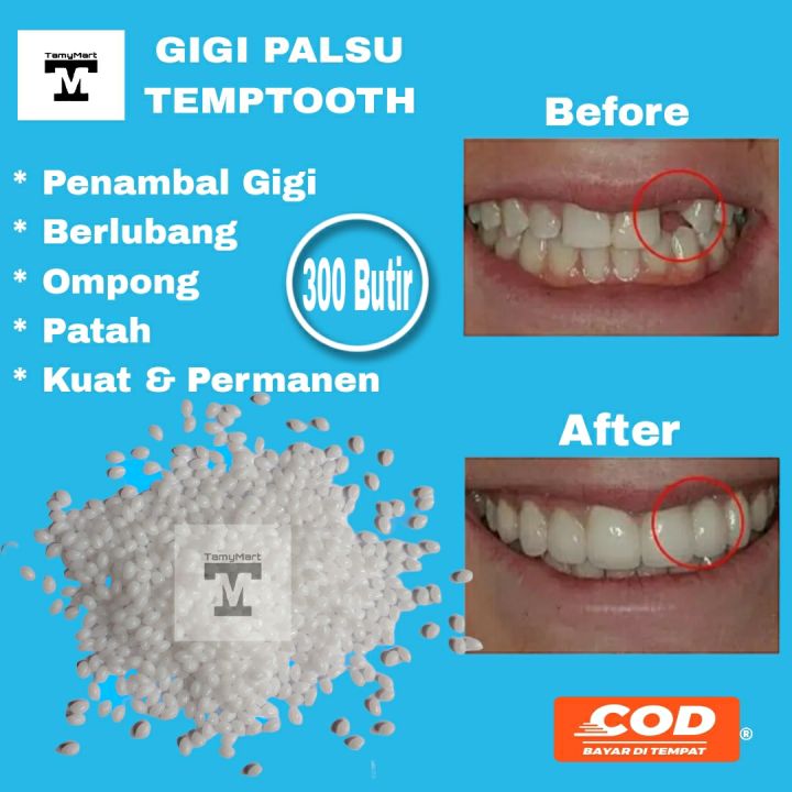 penambal gigi sementara/lem gigi isi 300 butir | Lazada Indonesia