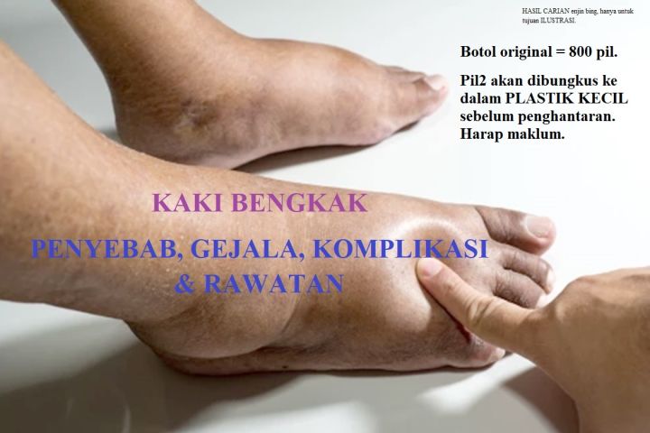 Sembab KAKI BENGKAK Air 双脚水肿 Leg Edema⭐LAINindividuLAINkesan#habiskan ...
