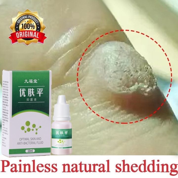 Foot Corn Warts Liquid Skin Tag Antibacterial Solution callus remover ...