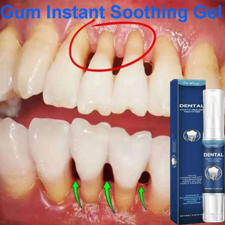 Rapid Repair Damaged Gums Gel Serum Relieve Sore Allergy Dental Caries ...