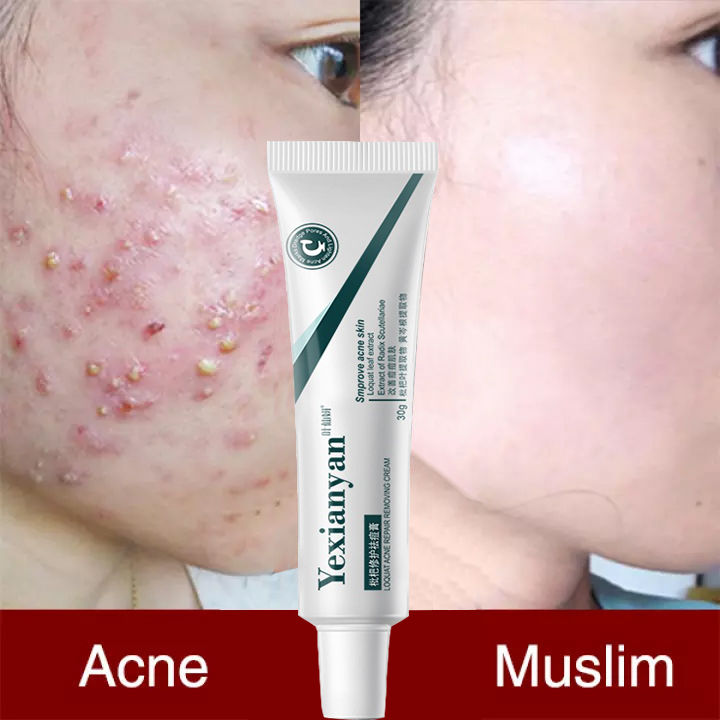 Acne cream Herbal acne cure, safe for children acne scar remover pimple ...
