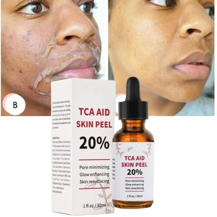 【Nuvio】 20% TCA aid skin peel pores 30ml trichloroacetic acid solution ...