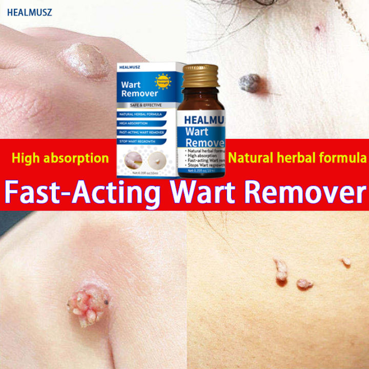 【HEALMUSZ】100% Effective Warts Remover Original Warts Magic Remover ...
