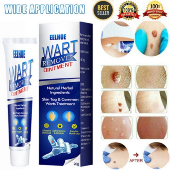 Warts Remover ORIGINAL Cream Wart Removal Ointment Kulugo Skin Tags ...