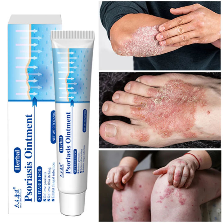 100 Valid 20g Psoriasis Antibacterial Cream Eczema Rash Treatment