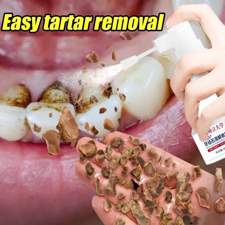 《317》Plaque Remover Calculus Dissolving Spray Teeth Whitening gel Pen ...