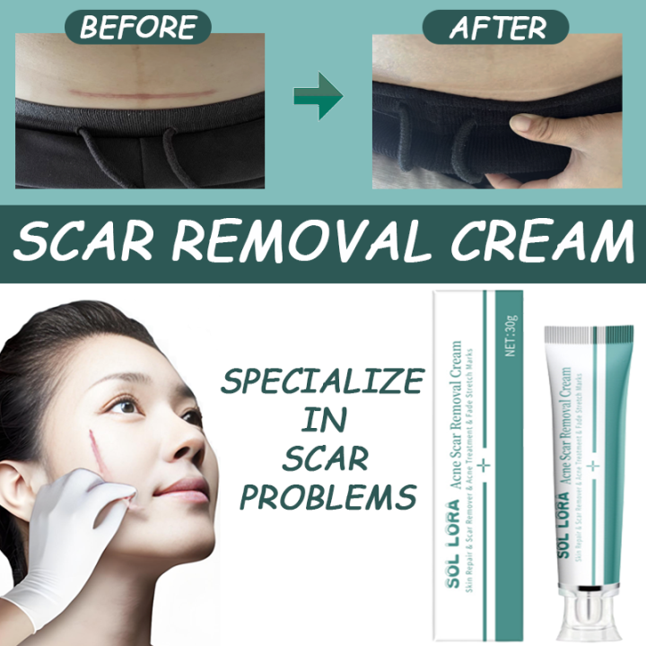 SOL LORA 30g scars disappear scars remover for old scars scar remover ...