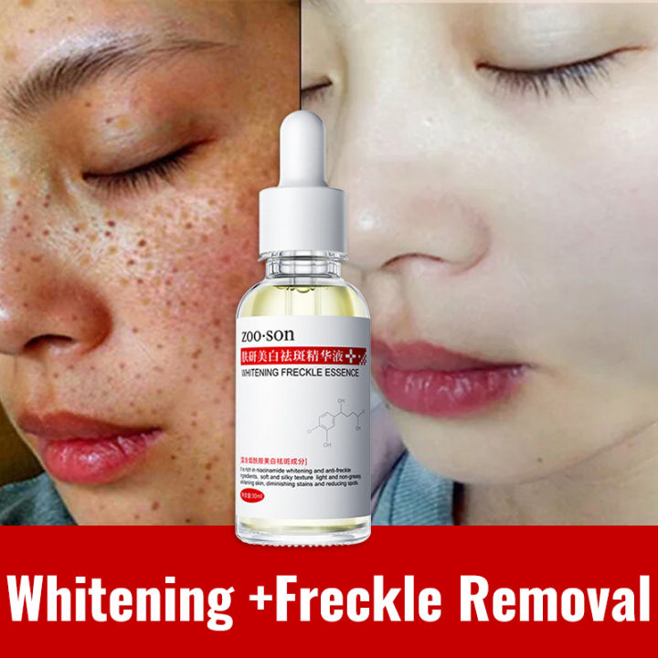 30ml Pekas Remover Serum For Whitening Melasma And Dark spot Melasma ...