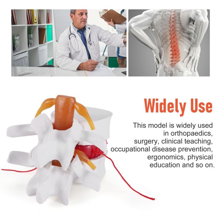 (GYIT) 1:1.5 Human Lumbar Disc Herniation Demonstration Model of Lumbar ...