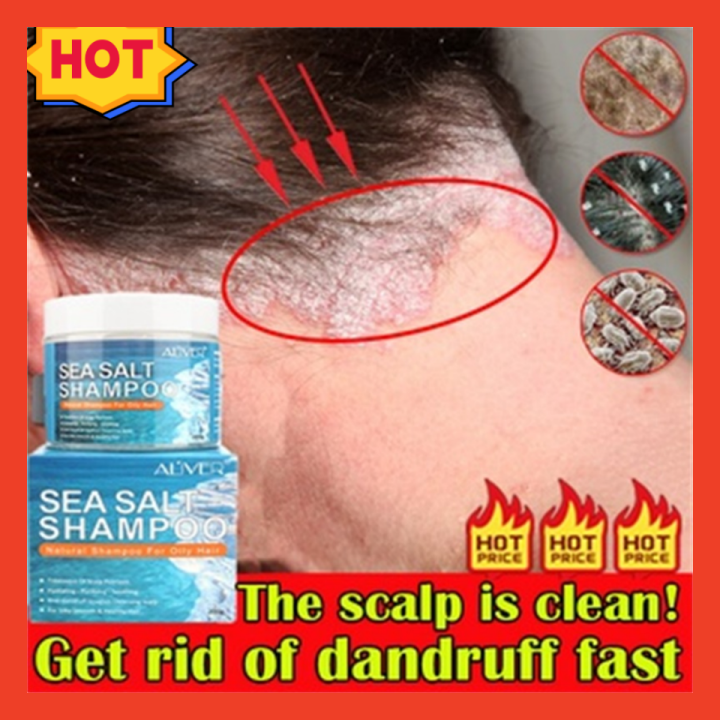 Original: Sea salt dandruff shampoo for treating dandruff and rapid ...