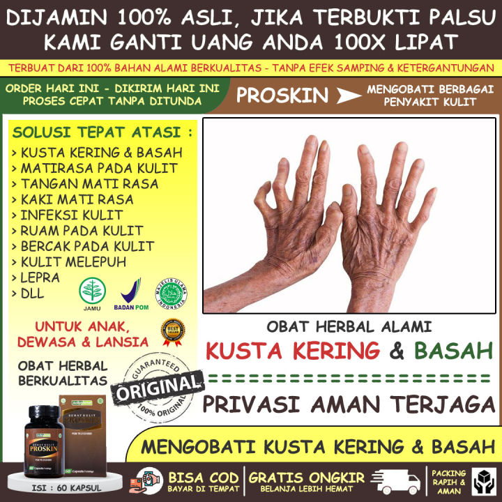 Obat Kusta Kering Matirasa Pada Kulit Tangan Dan Kaki Penyakit Lepra ...