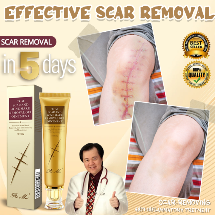 scar remover scars remover for old scars fix scar removal original ...
