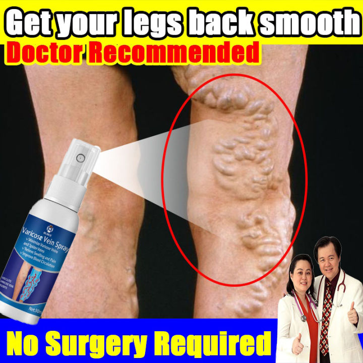varicose veins spray original 30ML varicose vein removal spray varicose ...