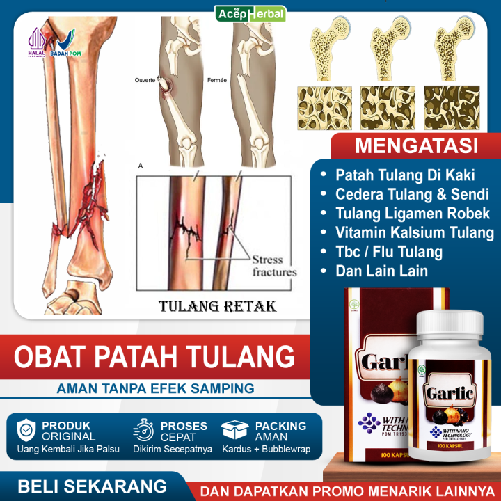 Obat Patah Tulang Dan Retak Bengkak Remuk Luka Dalam Nyeri Sendi ...