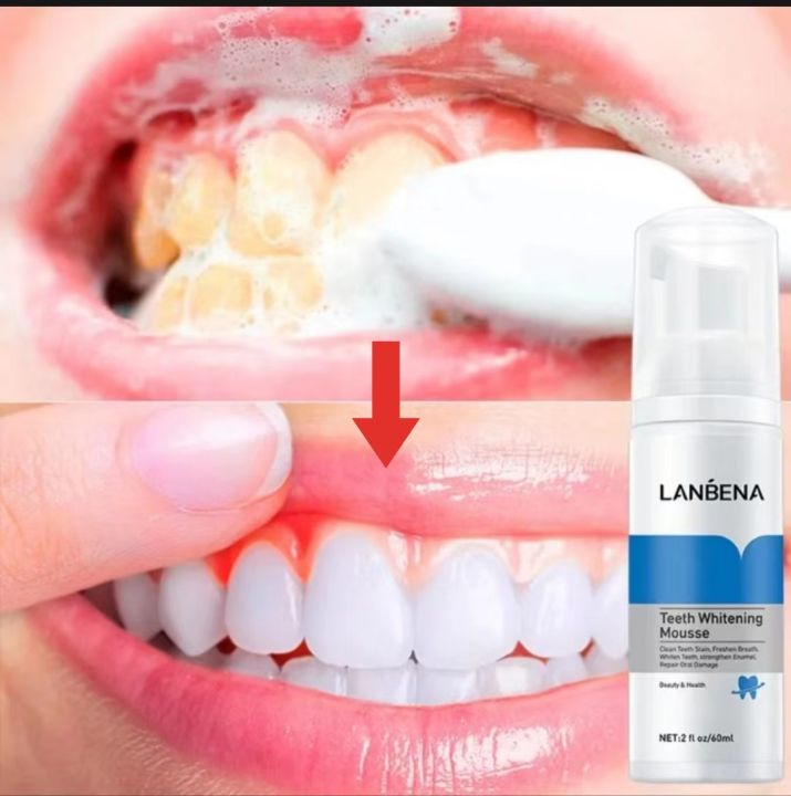 [LANBENA] Tooth whitening mousse toothpaste can remove plaque, stains ...