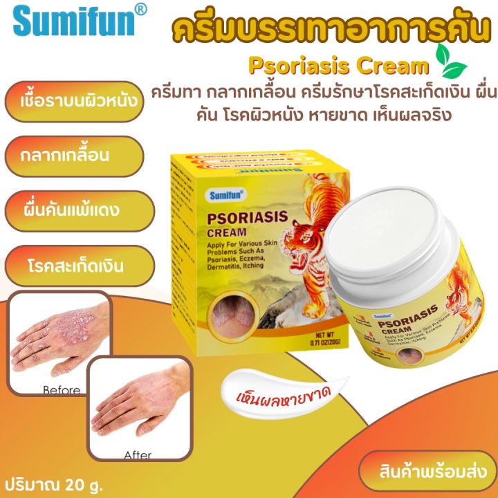 💯👽พร้อมส่ง!! Sumifun Psoriasis Cream 20g.ของแท้ 100% พร้อมส่งในไทย ครีม ...