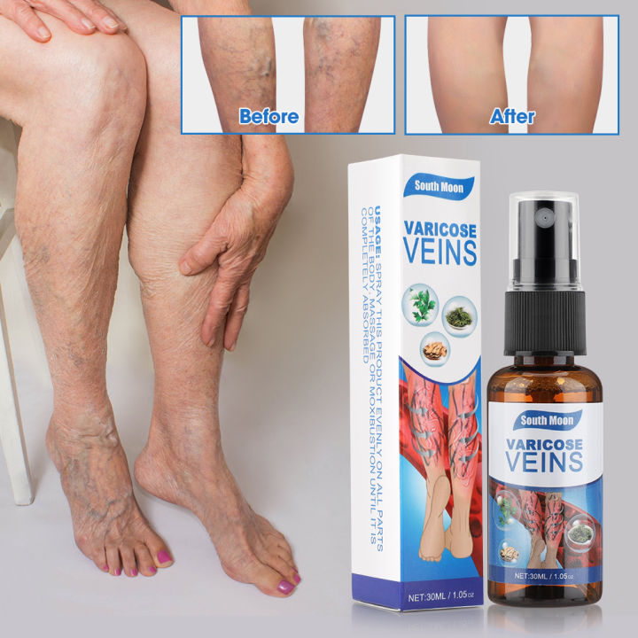 Varicose Vein Spray Smoothes Legs Blood Vessel Bulges Phlebitis Spider ...