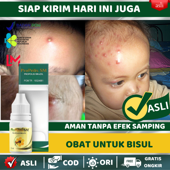 Obat Bisul, Bisul Bernanah, Bisul Di Kepala Bayi / Anak / Dewasa, Bisul ...