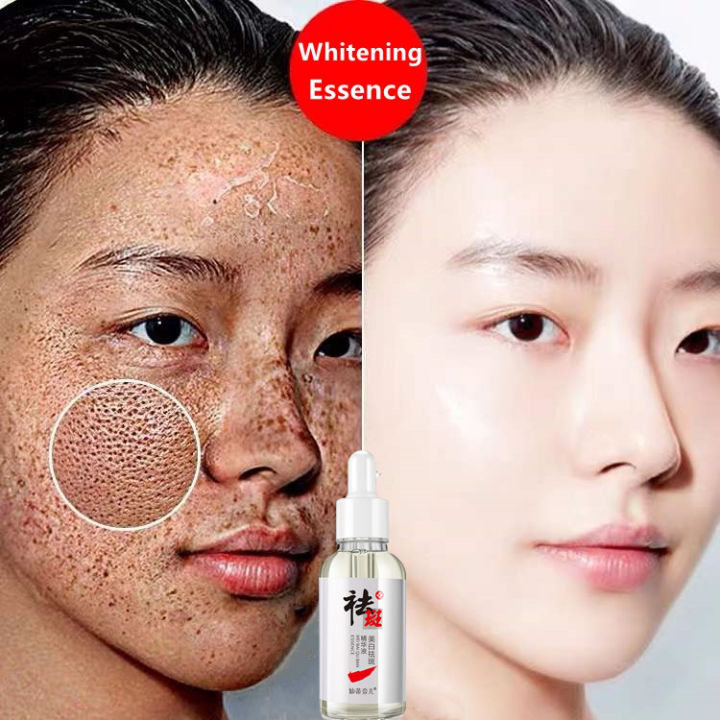 Whitening Freckle Facial Serum Dark Corrector Powerful Removing Melasma Melanin Dark Spots ...