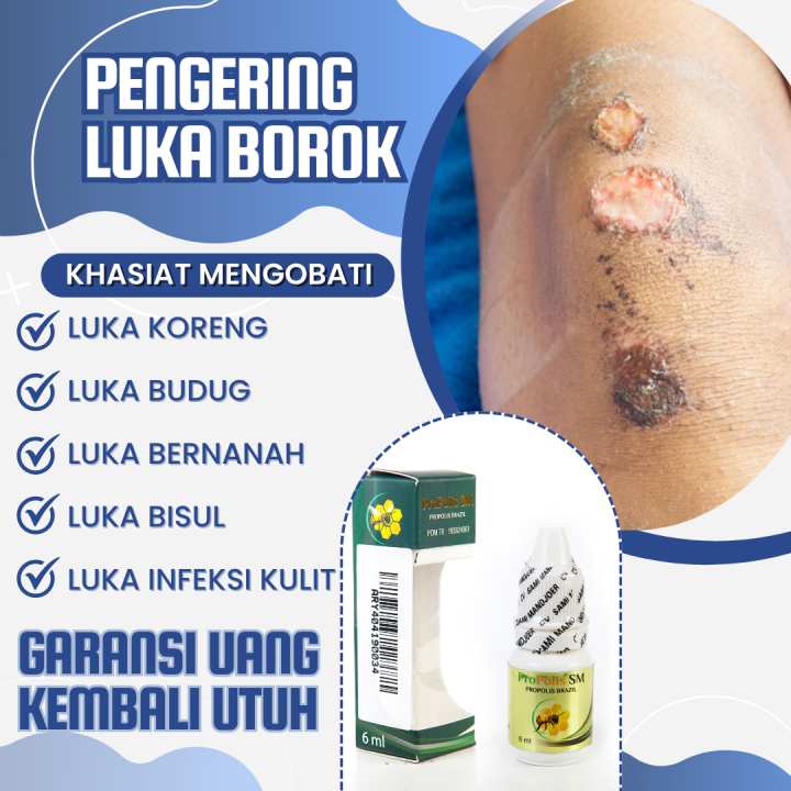 Obat Pengering Luka Borok, Luka Basah, Penghilang Bekas Luka Koreng ...
