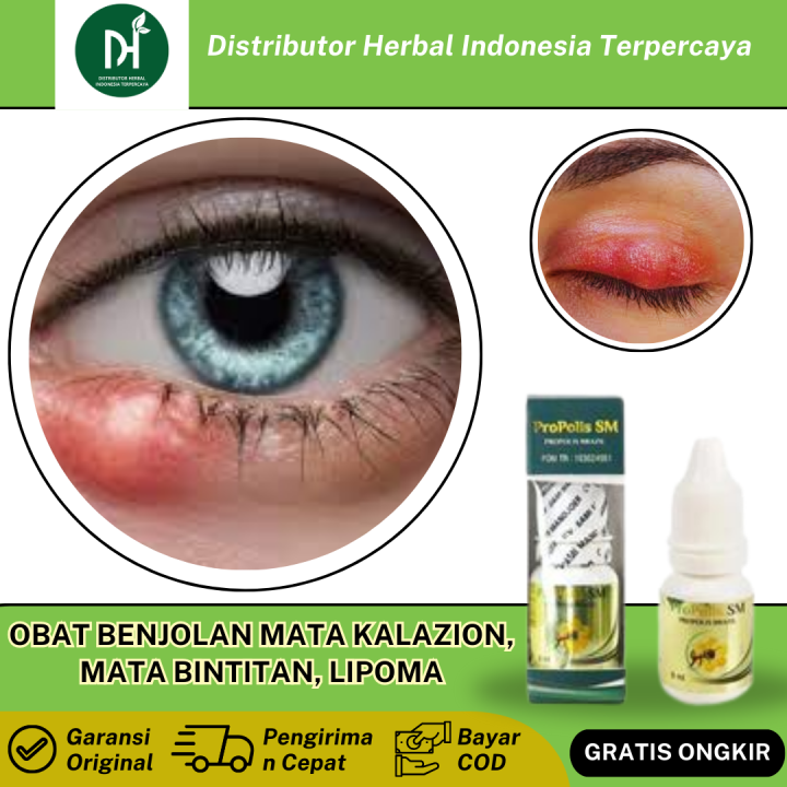 Obat Mata Benjolan Kalazion, Mata Bintitan, Obat Oles Mata Bintitan ...