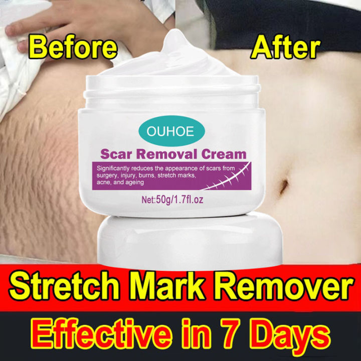 Scar Remove Cream 50g Stretch Mark Cream Old Scar Remover Repair ...