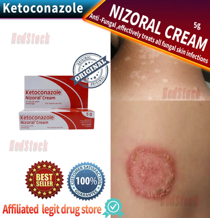 Nizoral Cream treats all fungal skin infections/katikati Galis | Lazada PH
