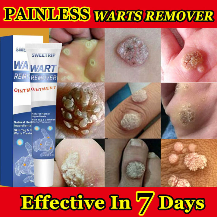 💖Safe Painless💖Warts Remover Original Cream Warts Magic Remover Wart ...