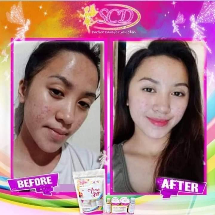 SCD Acne Care Set w/ FREEBIES- (Inclusions: Sulfur Soap, Cleansing ...