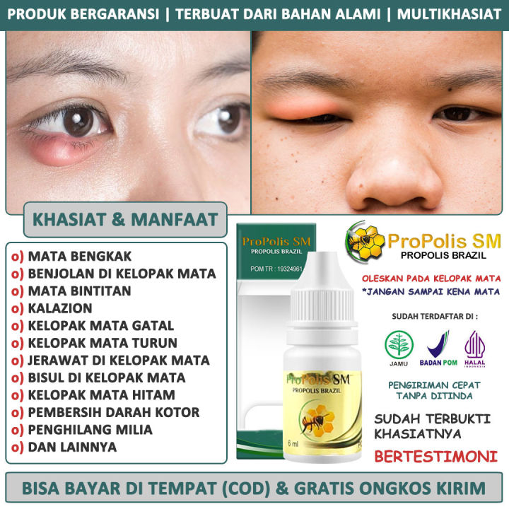 Obat Mata Bengkak Kalazion Benjolan Di Kelopak Mata Bintitan Ptosis ...