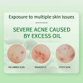 Effective Anti Acne Cream TeaTree Ampuh Mengatasi Jerawat Krim ...
