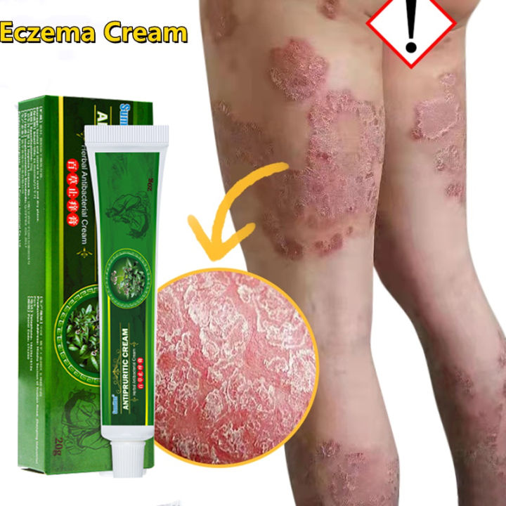 Antibacterial and antipruritic cream 20g Foot Ringworm Sweating Herpes ...