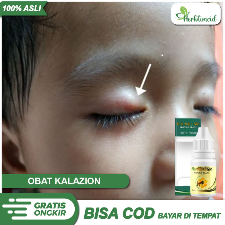 Obat Kalazion Anak dan Dewasa - Benjolan di Kelopak Mata Bawah / Atas ...