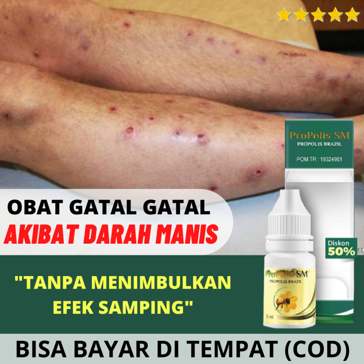 Obat Prurigo Darah Manis - Obat Darah Manis, Obat Kulit Gatal Gatal ...