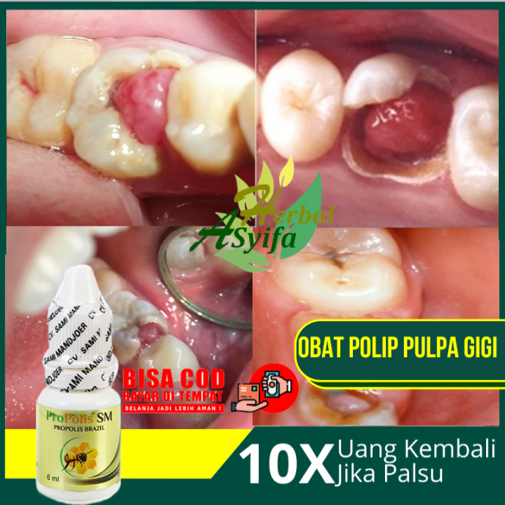 Cod! Obat Polip Pulpa Gigi, Obat Polip Pulpa Anak, Menghilangkan Polip ...