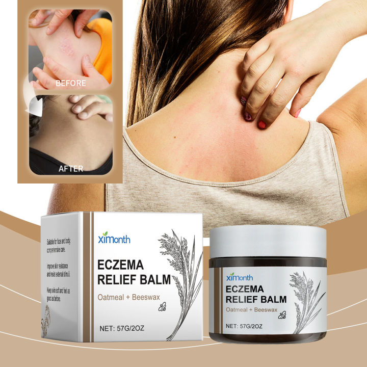 Ximonth Eczema Relief Balm Cream Treatment Dermatitis Eczema Anti-Itch Ointment Relieve Rash ...