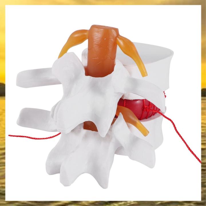 (VMHJ) 1:1.5 Human Lumbar Disc Herniation Demonstration Model of Lumbar ...
